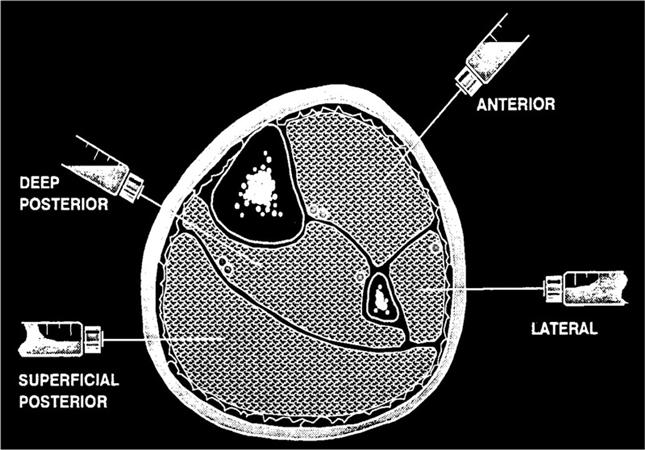 Compartment Syndrome Pearls And Pitfalls Emdocs