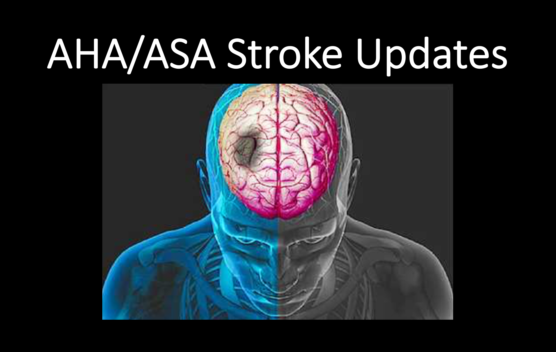 EmDOCs Emergency Medicine Education2018 AHA ASA Ischemic Stroke EmDOCs Emergency Medicine Education2018 AHA ASA Ischemic Stroke