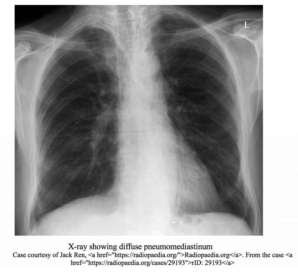 Emergency Medicine Educationesophageal Perforation Pearls