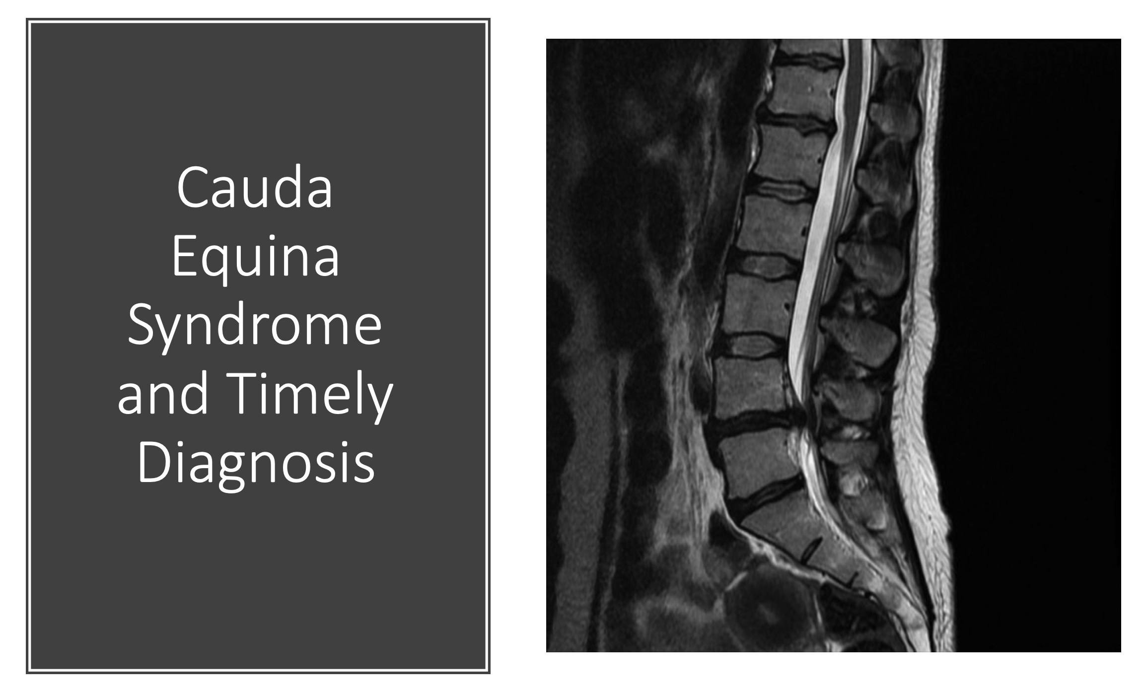 Cauda Equina Mri Cauda Equina Mri