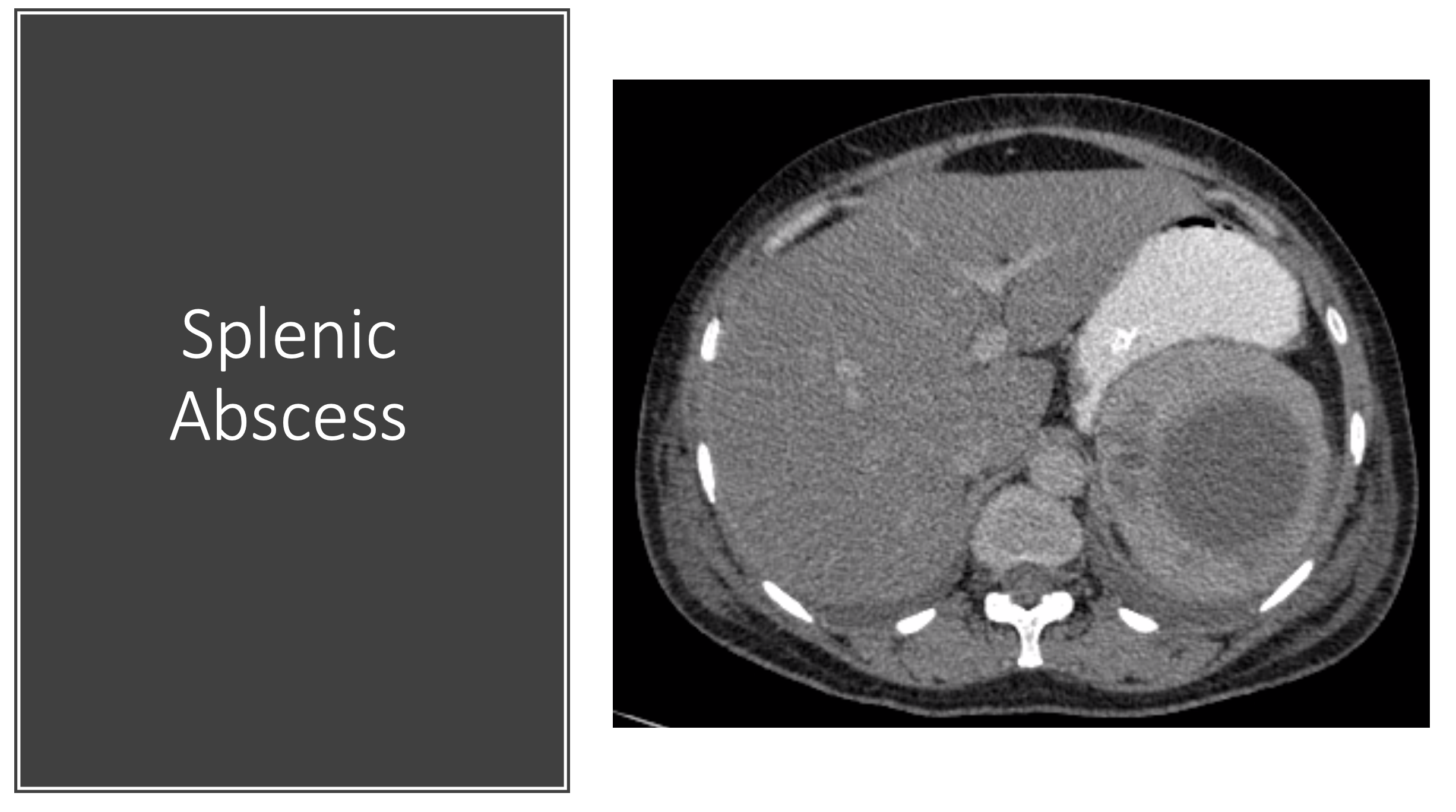 Emergency Medicine Educationsplenic Abscess Ed Presentation Evaluation And
