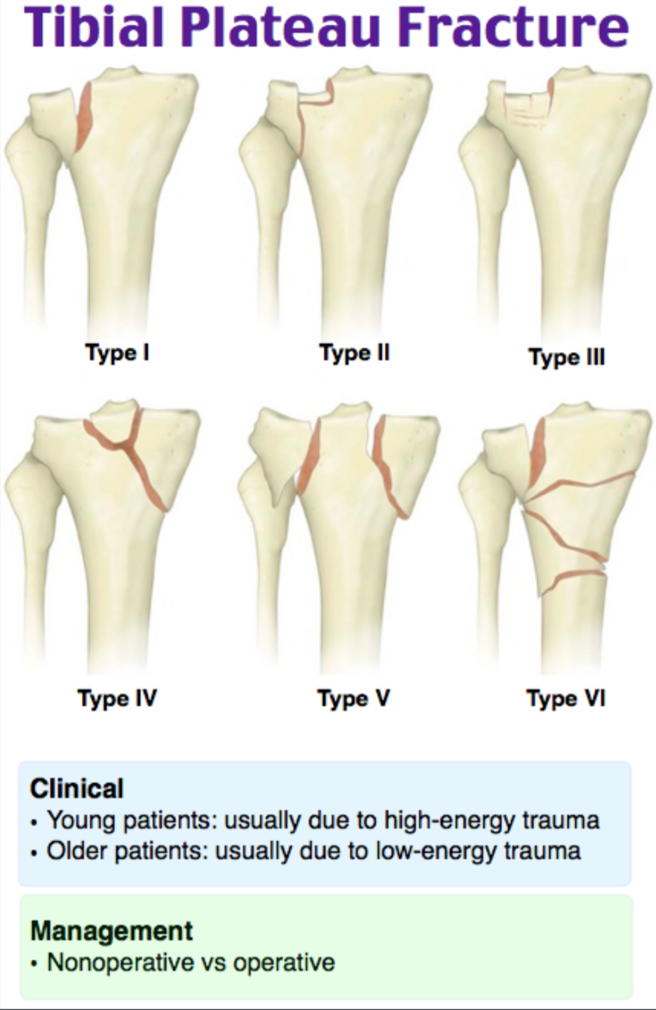Tibial Plateau Fracture Causes Types Symptoms Diagnosis My XXX Hot Girl