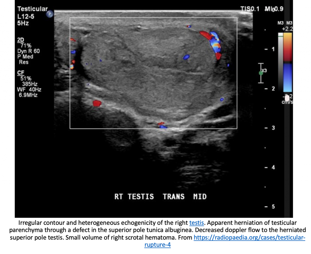 Emergency Medicine Educationem 3am Testicular Rupture