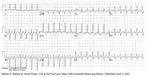 Atrial Flutter Vs Atrial Fibrillation