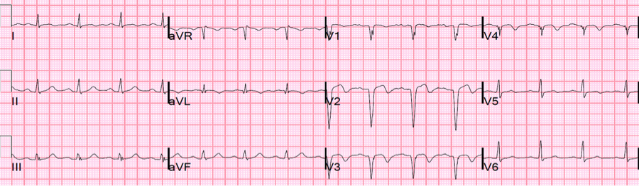 emDOCs.net – Emergency Medicine EducationLV aneurysm 5 - emDOCs.net ...