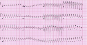 Amiodarone vs Procainamide for Stable VT - emDocs