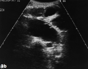 emDOCs.net – Emergency Medicine EducationUltrasound for Small Bowel ...
