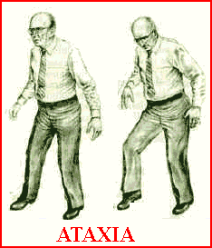 Acute Ataxia in the ED Highlights - emdocs