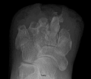 Osteomyelitis Amputation