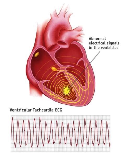 Refractory Ventricular Tachycardia: Approach to Management - emdocs