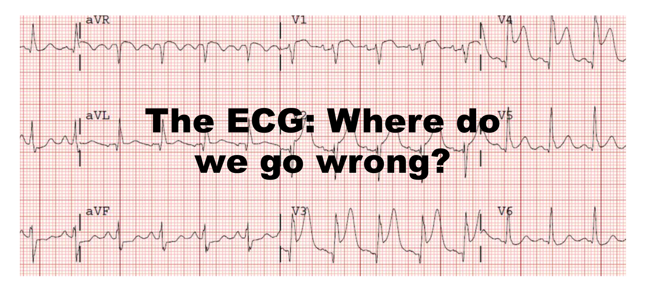 emDOCs.net – Emergency Medicine EducationECG analysis Archives - emDOCs ...