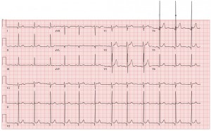 emDOCs.net – Emergency Medicine EducationSubtle ECG Findings in ACS ...