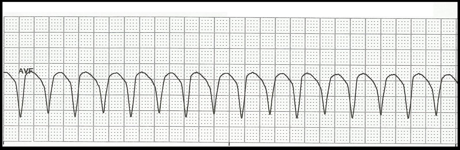 Stable Monomorphic Ventricular Tachycardia Management in the ED - emdocs