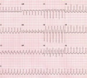 emDOCs.net – Emergency Medicine EducationEKG1 - emDOCs.net - Emergency ...