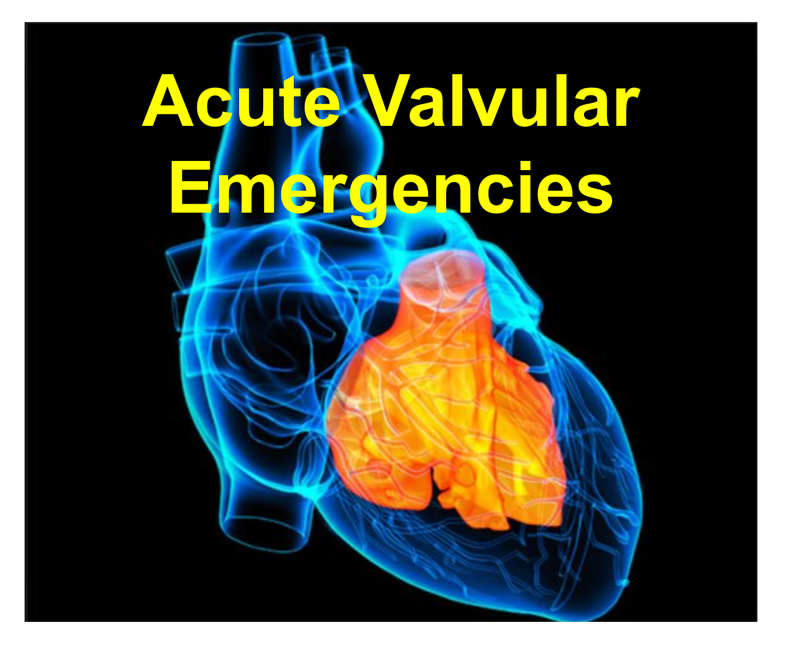 Acute Valvular Emergencies: Pearls and Pitfalls - emdocs