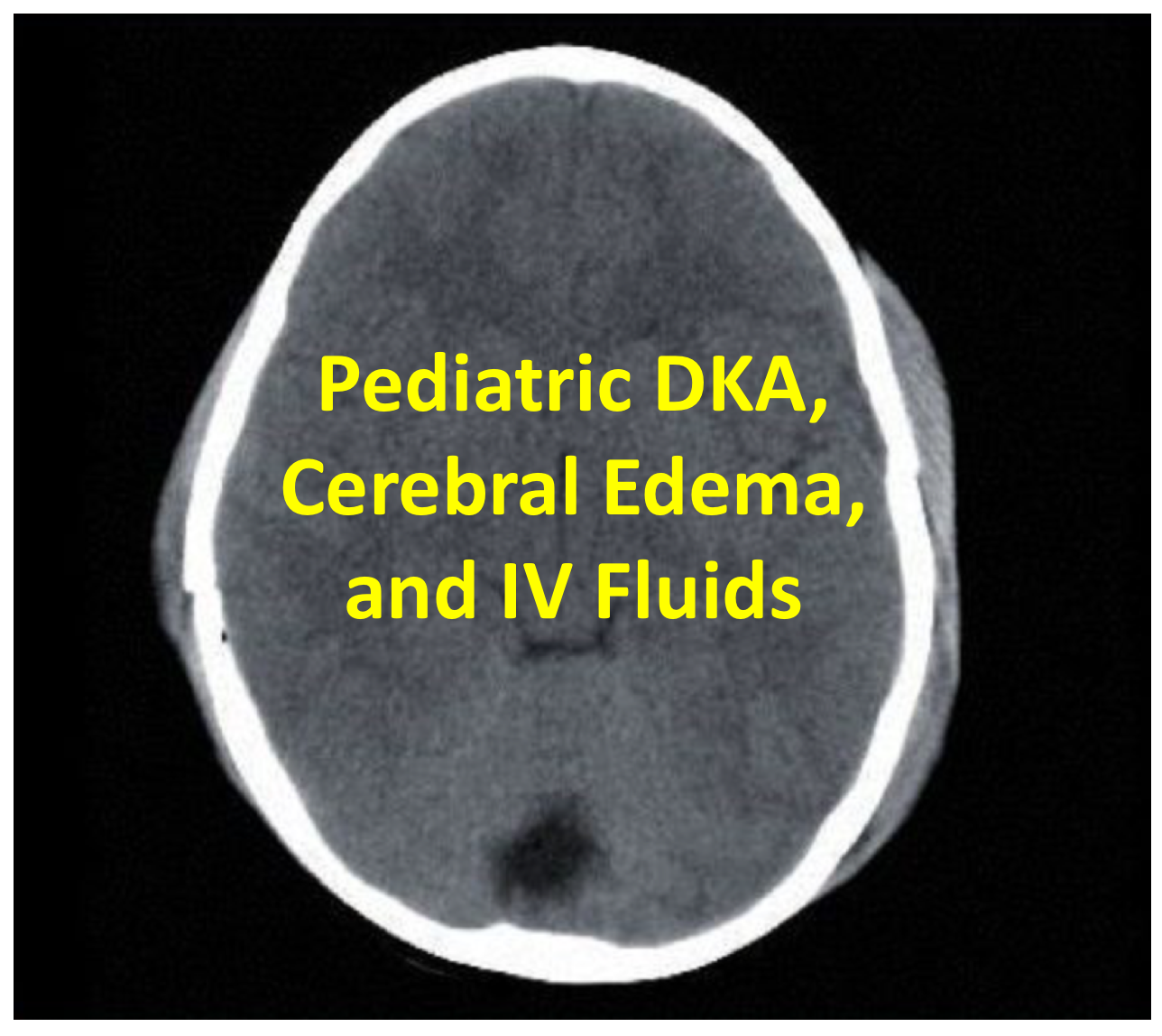 A Well-Grounded Myth? The Association of IV Fluids with Cerebral Edema ...