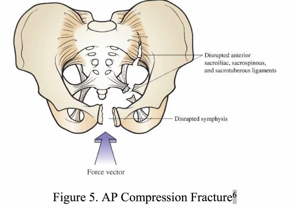 emDOCs.net – Emergency Medicine EducationPelvic fractures: ED ...