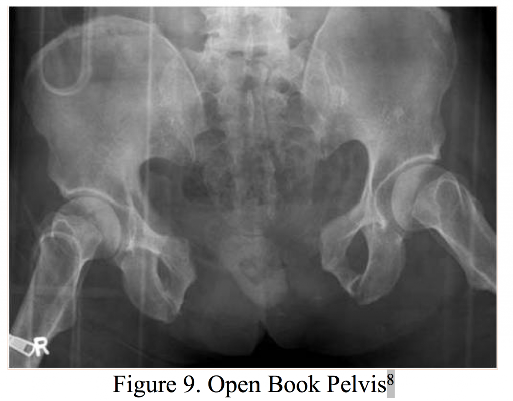 emDOCs.net – Emergency Medicine EducationPelvic fractures: ED ...