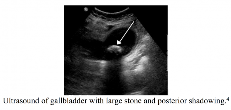 emDOCs.net – Emergency Medicine EducationBiliary Colic Mimics: What you ... emDOCs.net – Emergency Medicine EducationBiliary Colic Mimics: What you ...