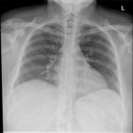 emDOCs.net – Emergency Medicine EducationComplications of CSF Shunts ...