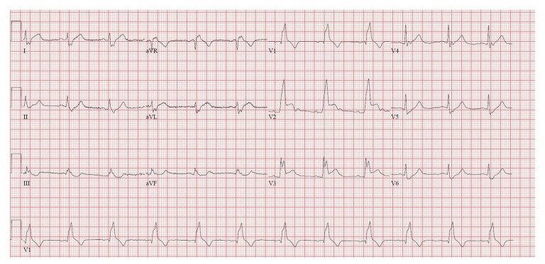 ECG Pointers: RBBB in ACS - emDocs