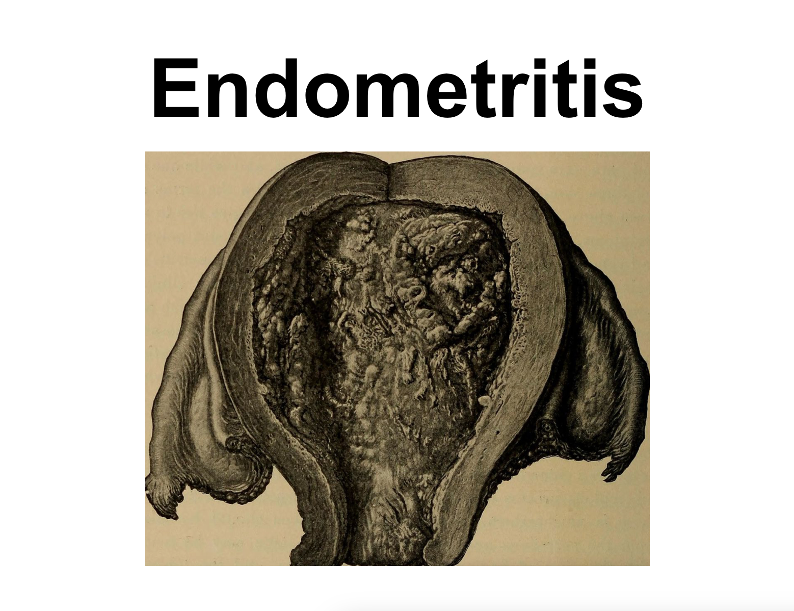 Postpartum Endometritis In The Ed Setting Presentation Evaluation And Management Emdocs