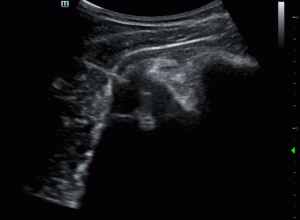 emDOCs.net – Emergency Medicine Educationlong clip of shoulder - emDOCs ...