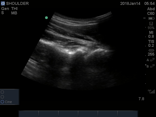 emDOCs.net – Emergency Medicine Educationshoulder anatomy blank ...