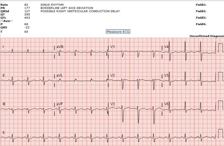 ECG Pointers: TCA Overdose - emDocs
