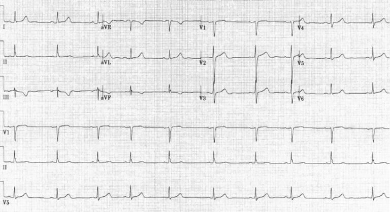 ECG Pointers: Limb Lead Reversal - emDocs