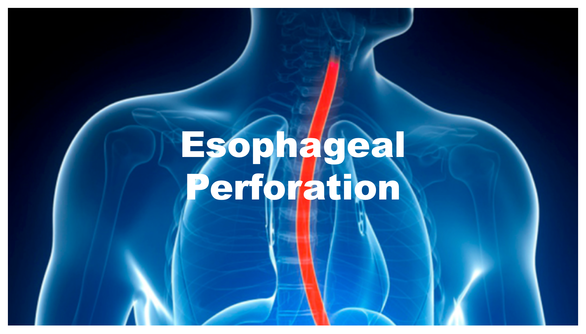 Esophageal Perforation: Pearls and Pitfalls for the Resuscitation Room ...