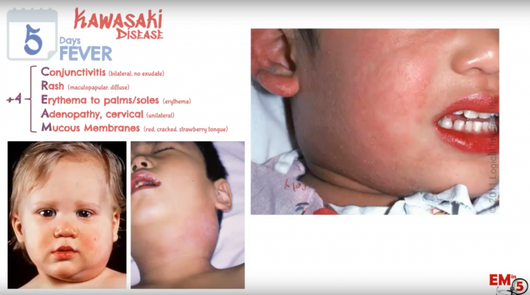 emDOCs.net – Emergency Medicine EducationEM in 5: Kawasaki Disease ...