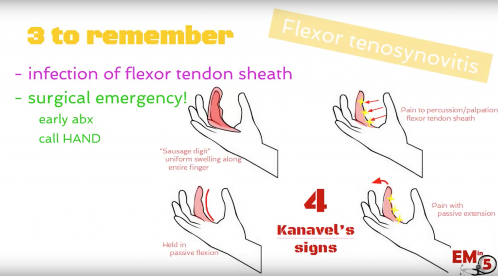 EM in 5: Flexor Tenosynovitis - emDocs