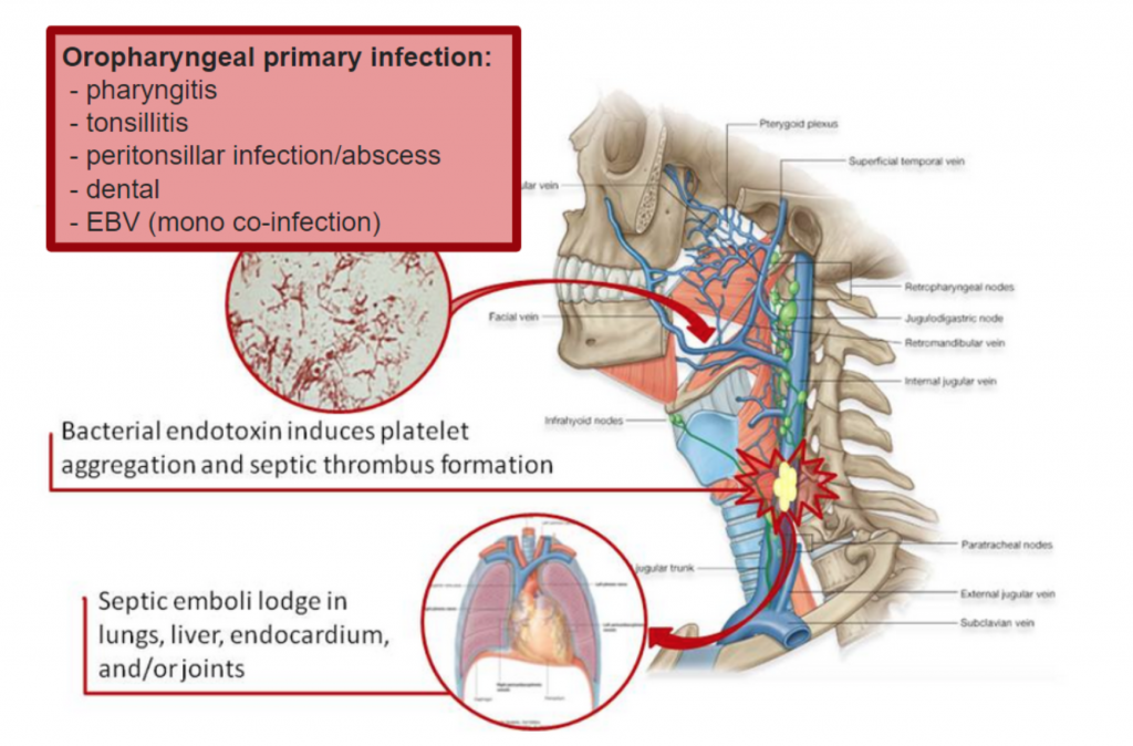 emDOCs.net – Emergency Medicine EducationEM in 5: Lemierre’s Syndrome ...