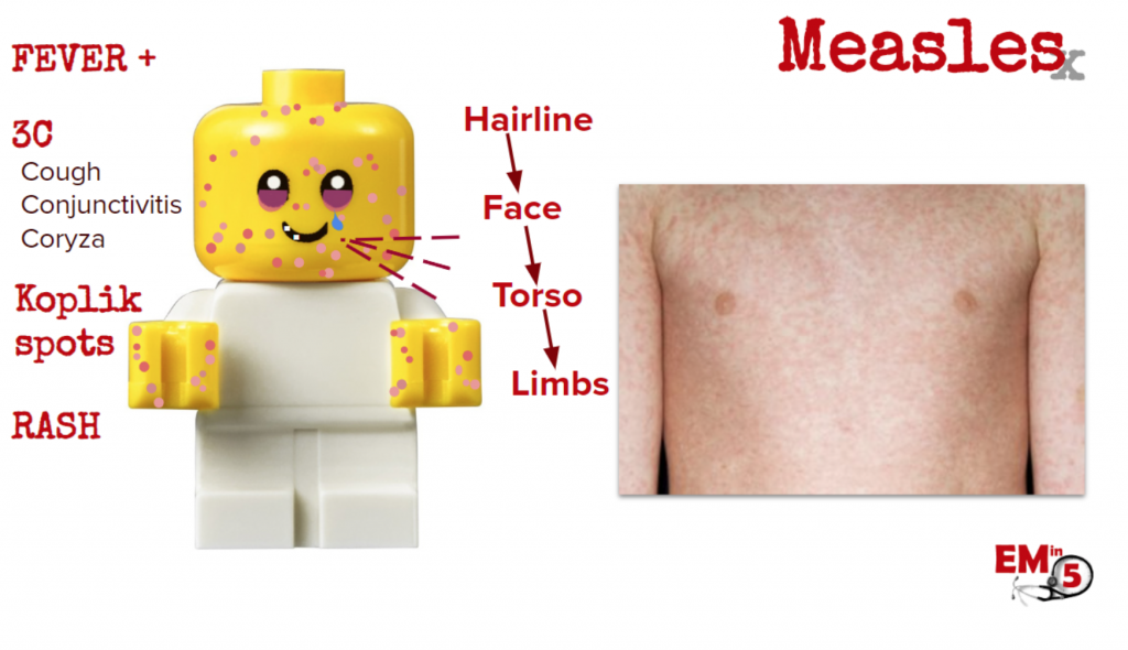emDOCs.net – Emergency Medicine EducationEM in 5: Measles - emDOCs.net ...