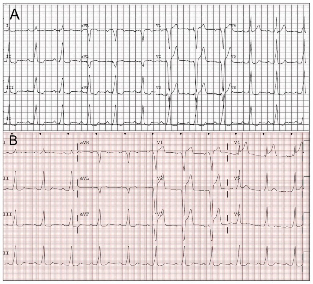 ECG Pointers: A Paced STEMI - emDocs