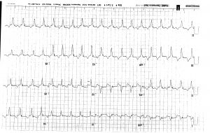 emDOCs.net – Emergency Medicine EducationECG Pointers: A Paced STEMI ...