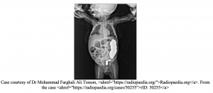 emDOCs.net – Emergency Medicine EducationConstipation Mimics ...