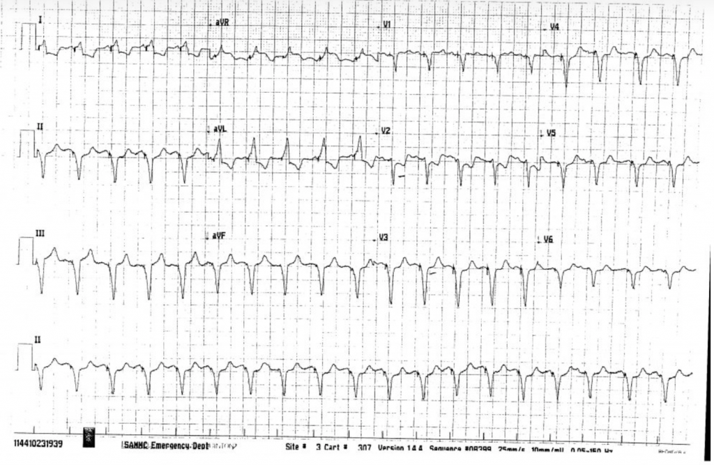 emDOCs.net – Emergency Medicine EducationECG Pointers: A Paced STEMI ...