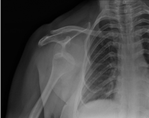 US Probe: Interscalene Nerve Block for Shoulder Dislocation - emDocs