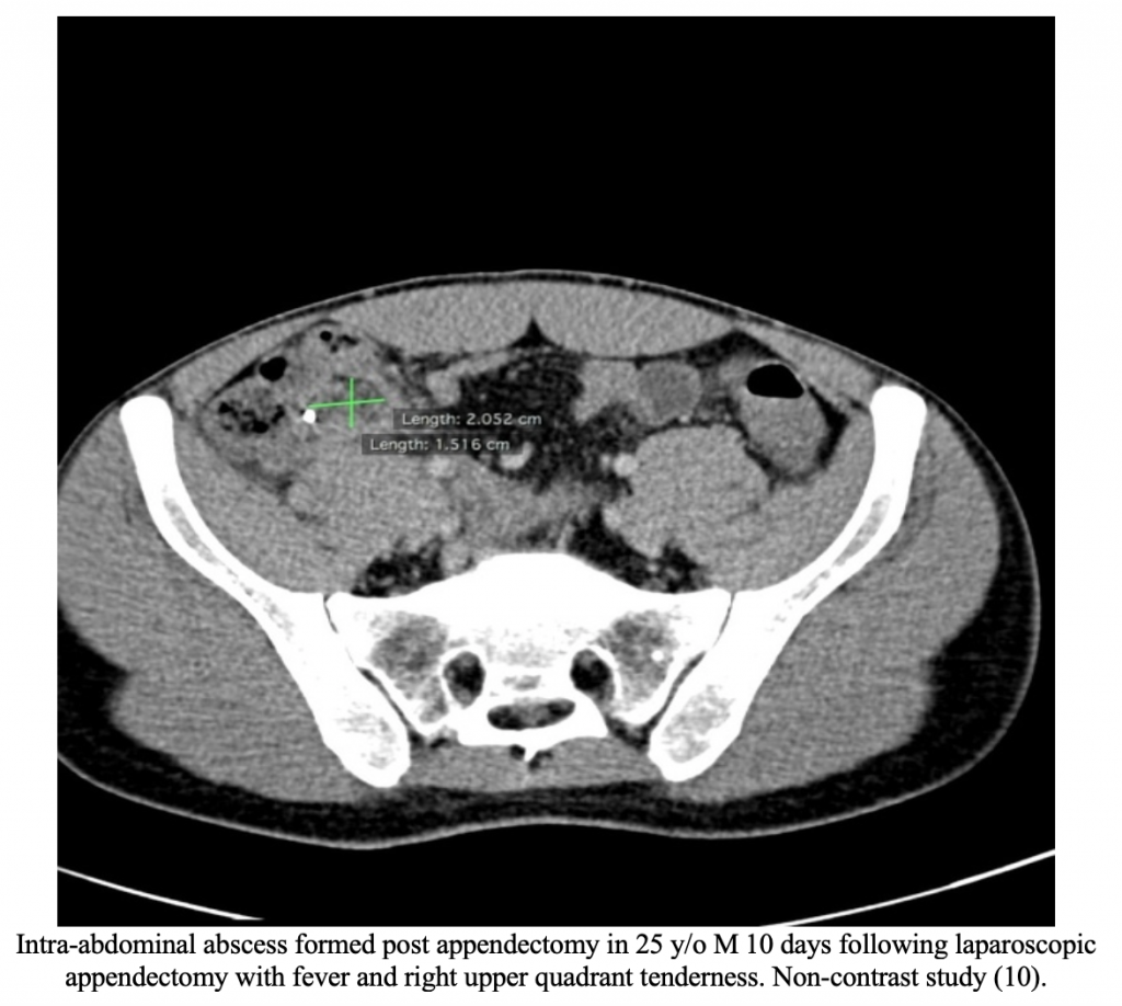 emDOCs.net – Emergency Medicine EducationIntra-abdominal Abscess ...