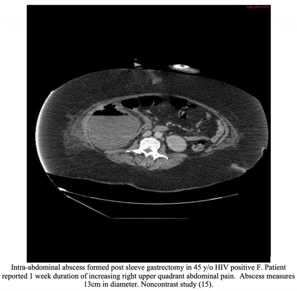 emDOCs.net – Emergency Medicine EducationIntra-abdominal Abscess ...
