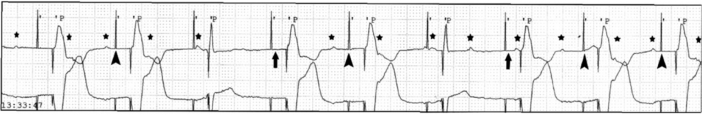 emDOCs.net - Educazione in Medicina d'EmergenzaECG Pointers: Pacemaker ...