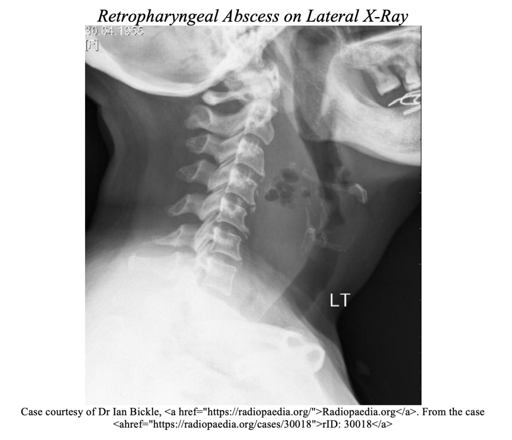 Stridor: ED presentations, evaluation, and management - emDocs