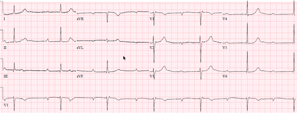 emDOCs.net – Emergency Medicine EducationECG Pointers: Pacemakers ...