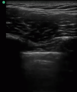 emDOCs.net – Emergency Medicine EducationNormal lung sliding - emDOCs ...