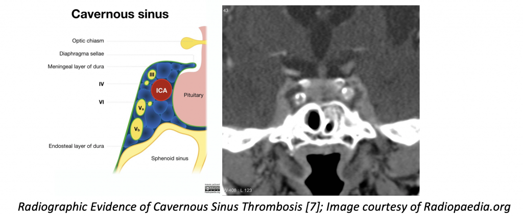 emDOCs.net – Emergency Medicine EducationDiplopia Evaluation and ...