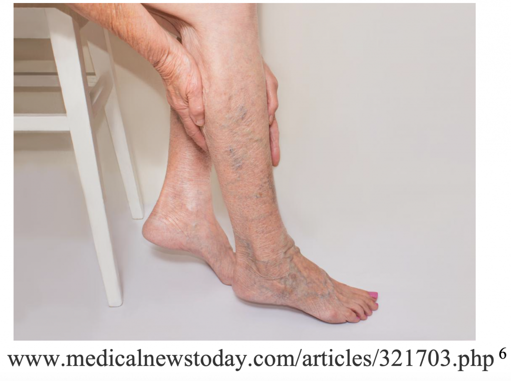 What To Expect At A Varicose Vein Screening