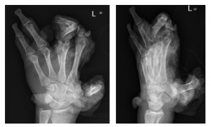 emDOCs.net – Emergency Medicine EducationFirework-related Injuries ...