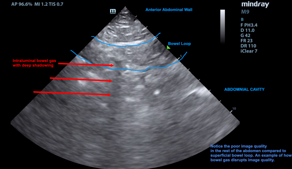 Us Probe Ultrasound For Diagnosis Of Pneumoperitoneum Emdocs